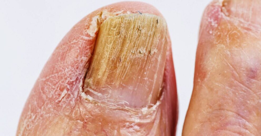 Babské rady na plíseň nehtů: 20 Tipů jak se jí zbavit doma